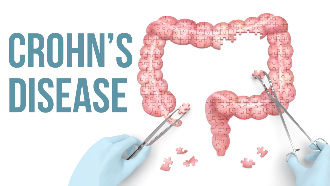 Crohns Disease Symptoms Cause Diagnosis And Treatment