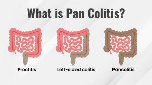Pancolitis: Symptoms, Causes, And Treatment